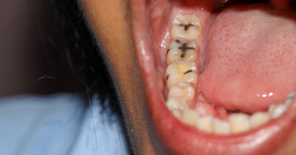 Can You Get Invisalign With Cavities? (Clear Aligners With Tooth Decay)