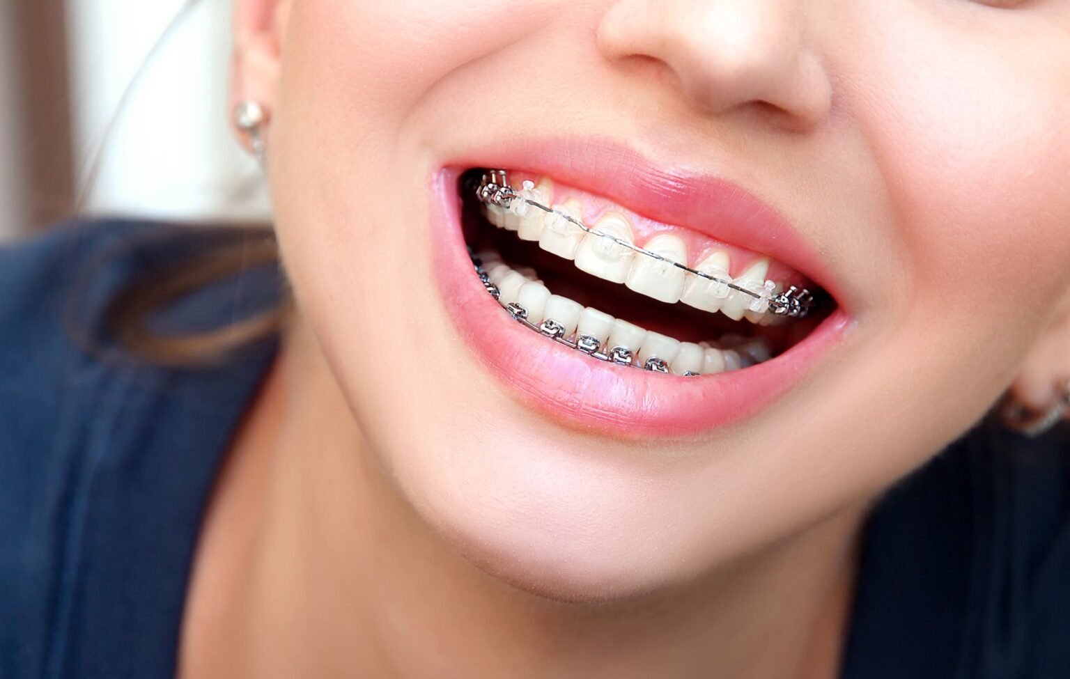 Clear Ceramic Braces: What They Are and How They Work - Tisseront ...